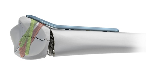 Medartis - GPS-Ofa.cz (Traumatologie, Aptus hand, Aptus radius ...